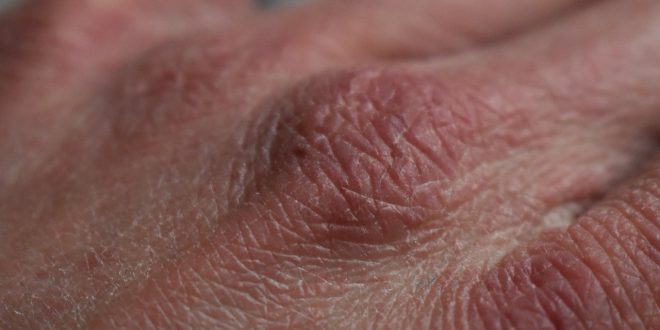 Pelle secca e irritata: cause e rimedi